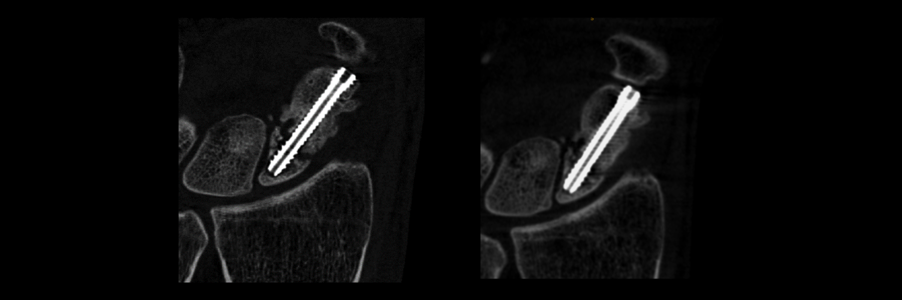 Reducing image artifacts in pre- and post-orthopaedic care – MARS ...